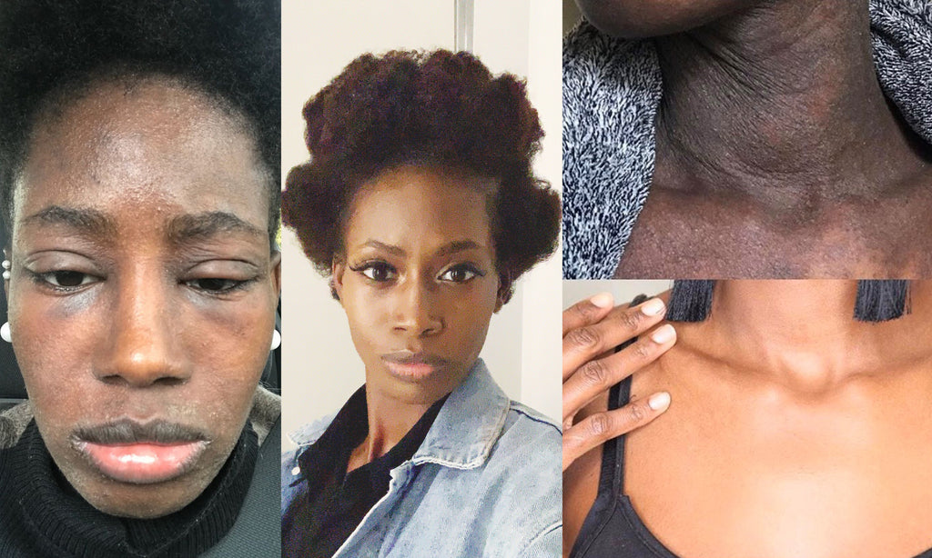 How I healed my eczema and how you can, too – Willowberry Skincare